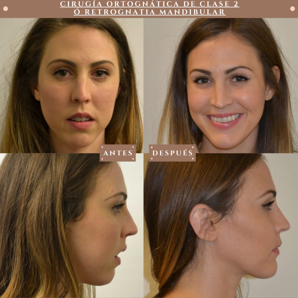 Cirugía Ortognática En Tijuana Cirujano Oral Y Maxilofacial En Tijuana