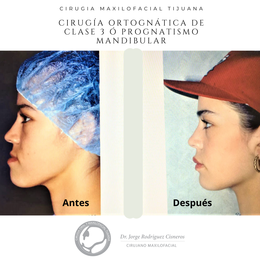 Cirugía Ortognática en Tijuana - Cirujano Oral y Maxilofacial en Tijuana