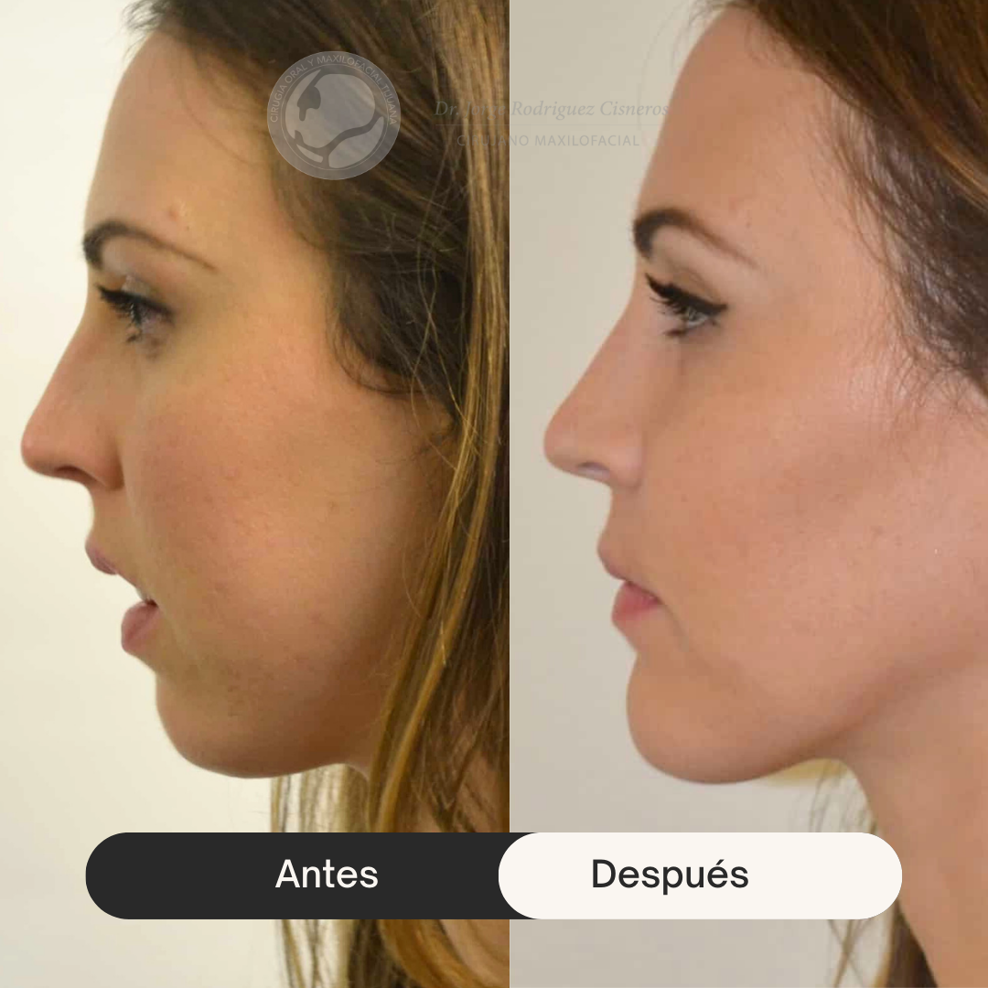 Cirugía Ortognática en Tijuana - Cirujano Oral y Maxilofacial en Tijuana